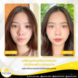 รีวิวฟิลเลอร์ปาก | Patcha Clinic
