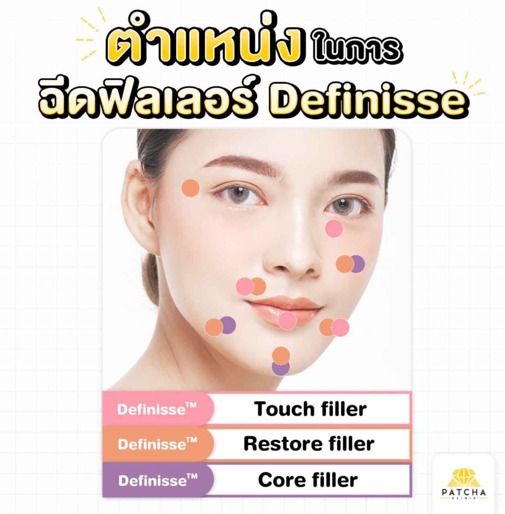 ฟิลเลอร์ Definisse ดีไหม มีกี่รุ่น ราคาเท่าไร