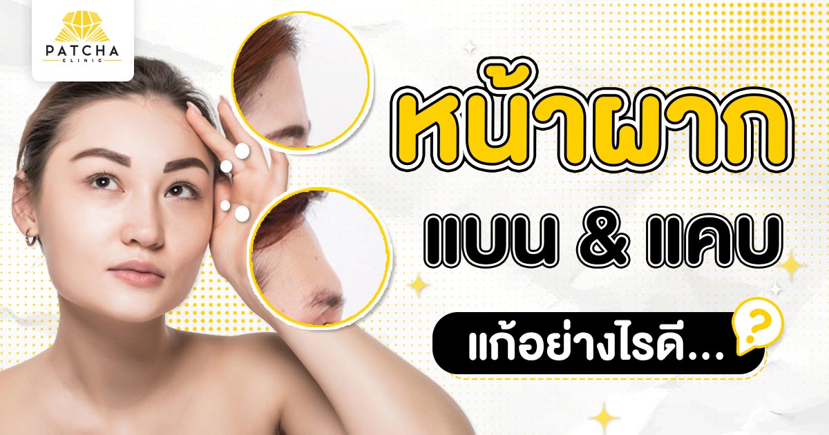 หน้าผากแบน หน้าผากแคบ ทำอย่างไรดี แก้ไขอย่างไรได้บ้าง