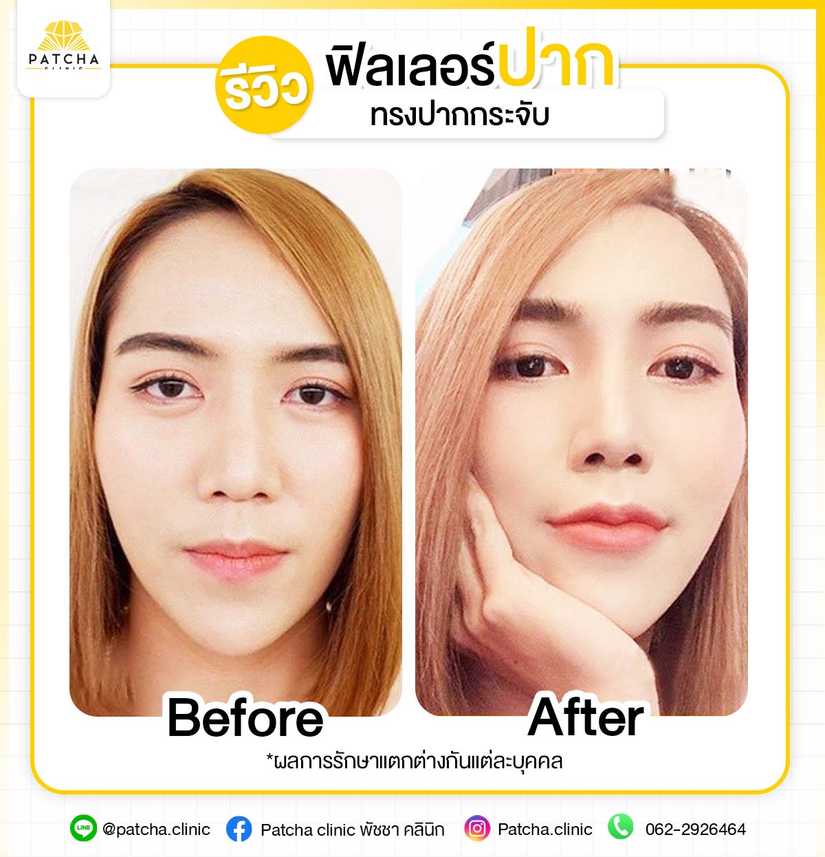 ฟิลเลอร์ปาก | Patcha Clinic