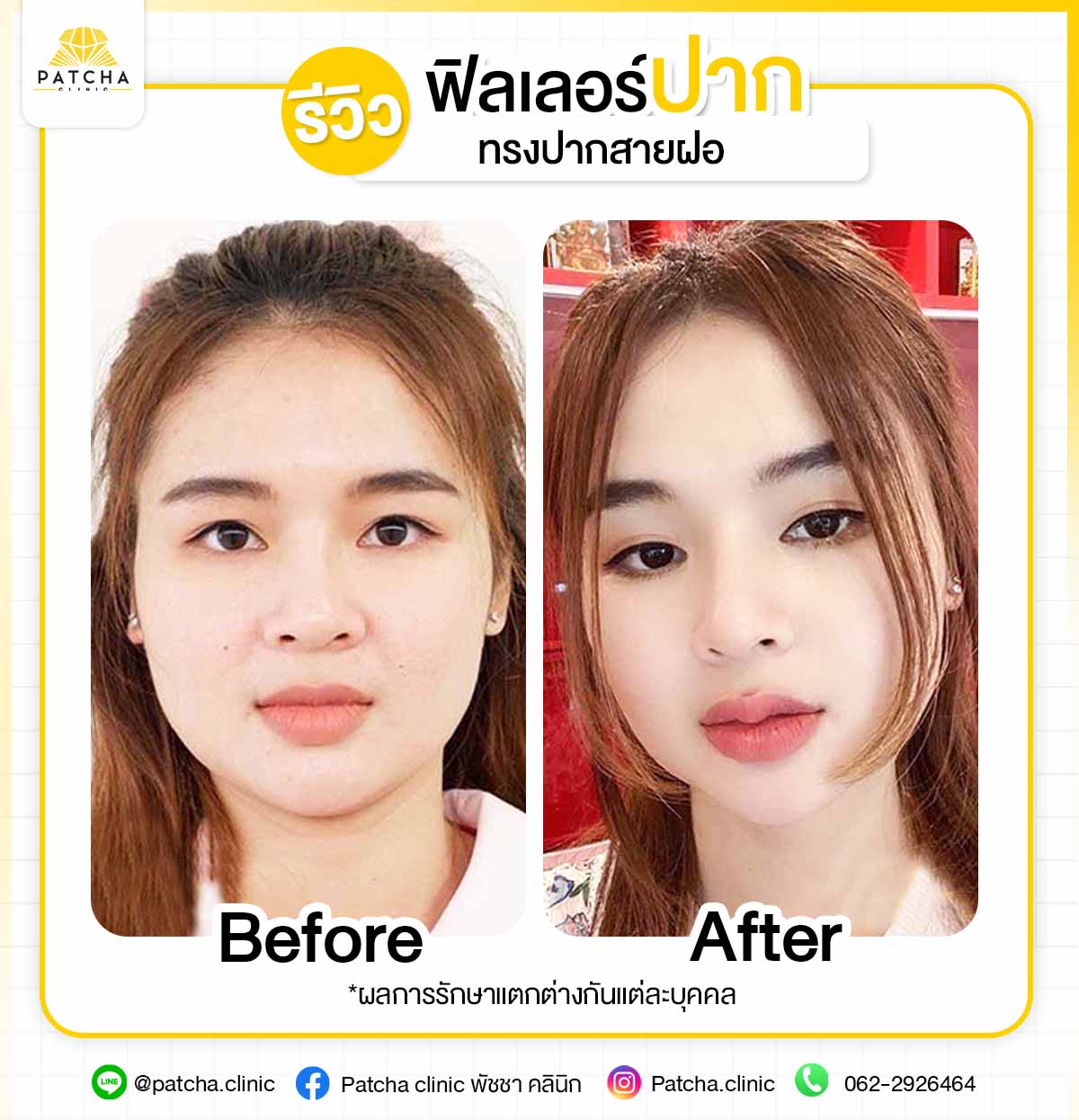 ฟิลเลอร์ปาก | Patcha Clinic
