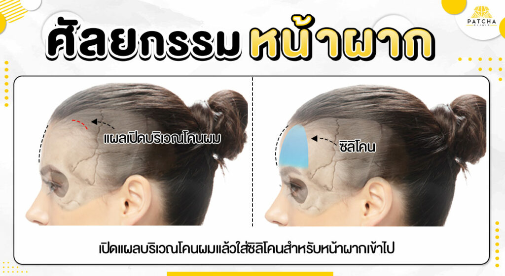 หน้าผากแบน หน้าผากแคบ ทำอย่างไรดี แก้ไขอย่างไรได้บ้าง