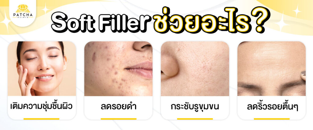 Soft filler คืออะไร ช่วยเรื่องอะไรได้บ้าง