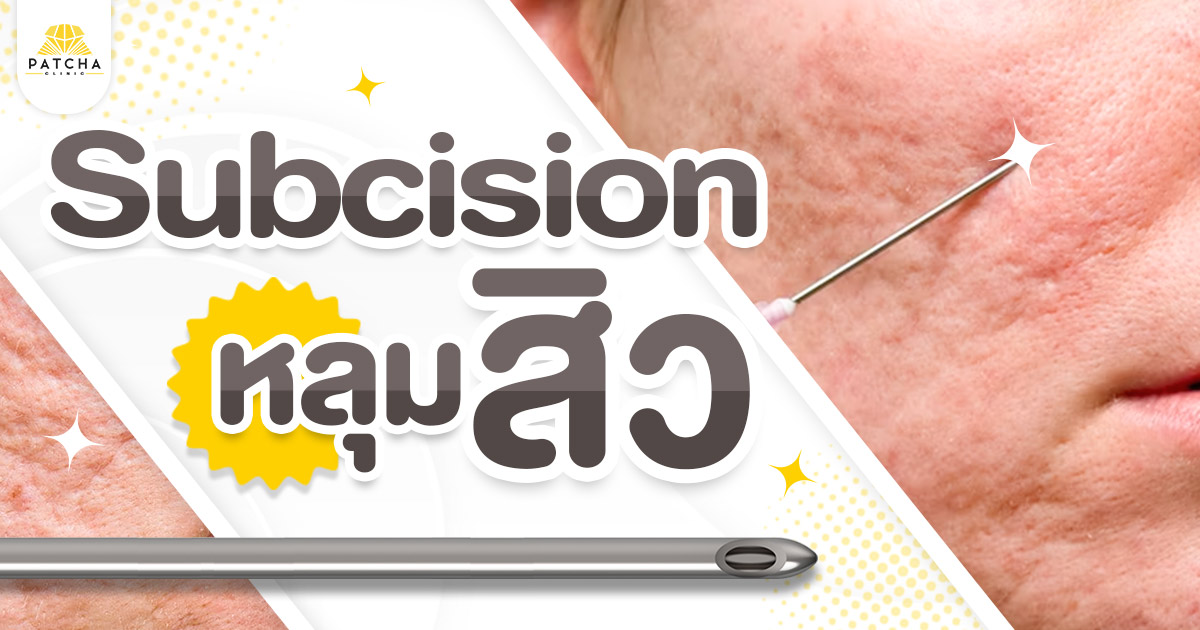 Subcision หลุมสิวคืออะไร ทำดีไหม