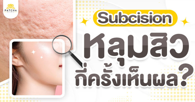Subcision หลุมสิวกี่ครั้งเห็นผล ทำบ่อยไหม