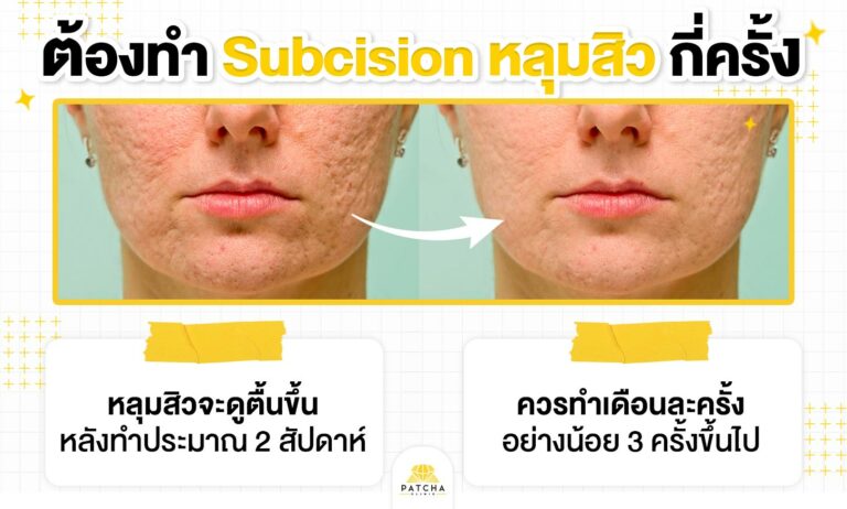Subcision หลุมสิวกี่ครั้งเห็นผล ทำบ่อยไหม