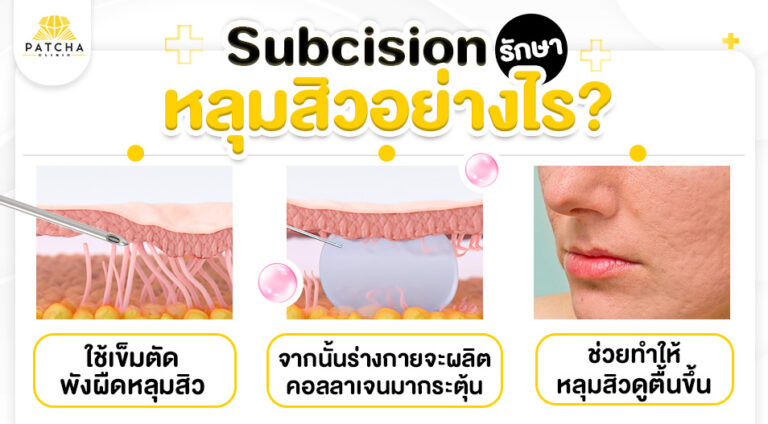 Subcision หลุมสิวคืออะไร ทำดีไหม