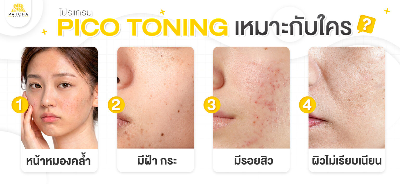 Pico Toning คืออะไร ดียังไง หลังทำมีความเปลี่ยนแปลงไหม